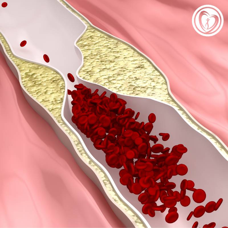 Oclusão Arterial Aguda - Endocore