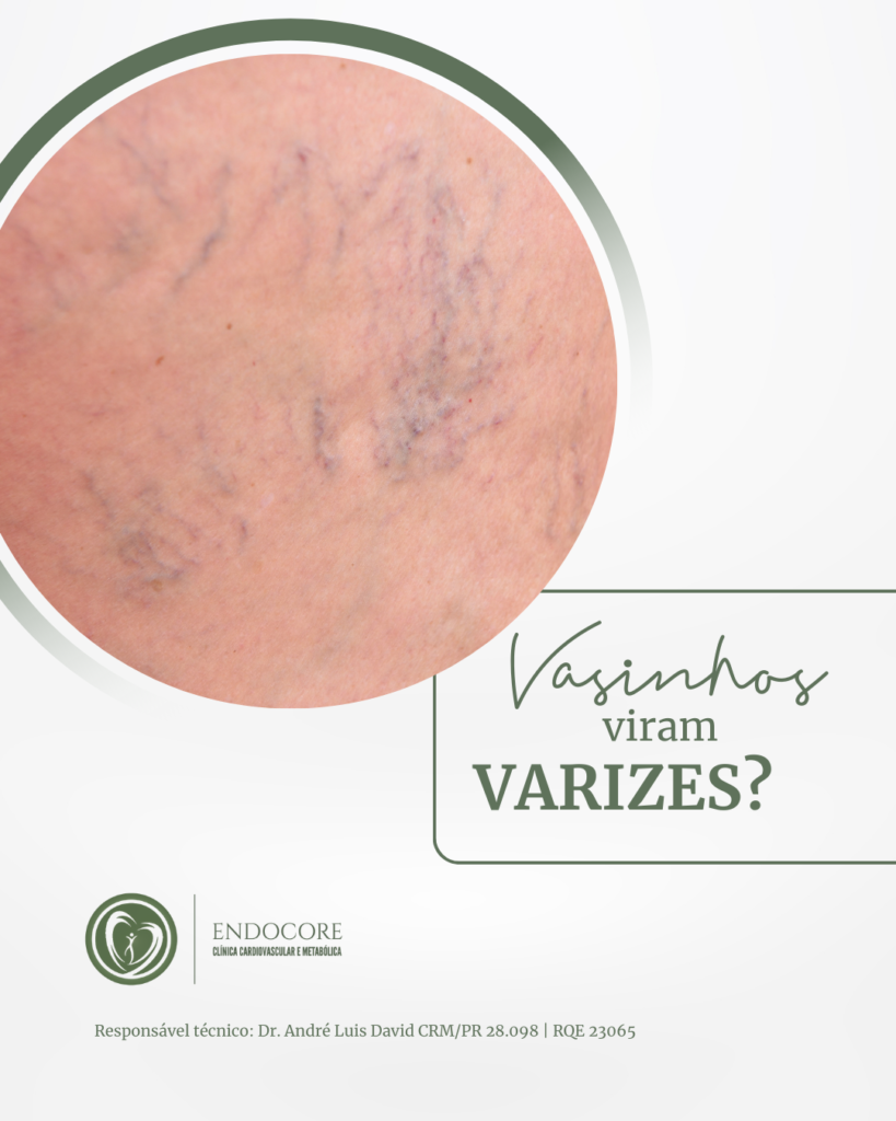 Vasinhos viram varizes? - Endocore