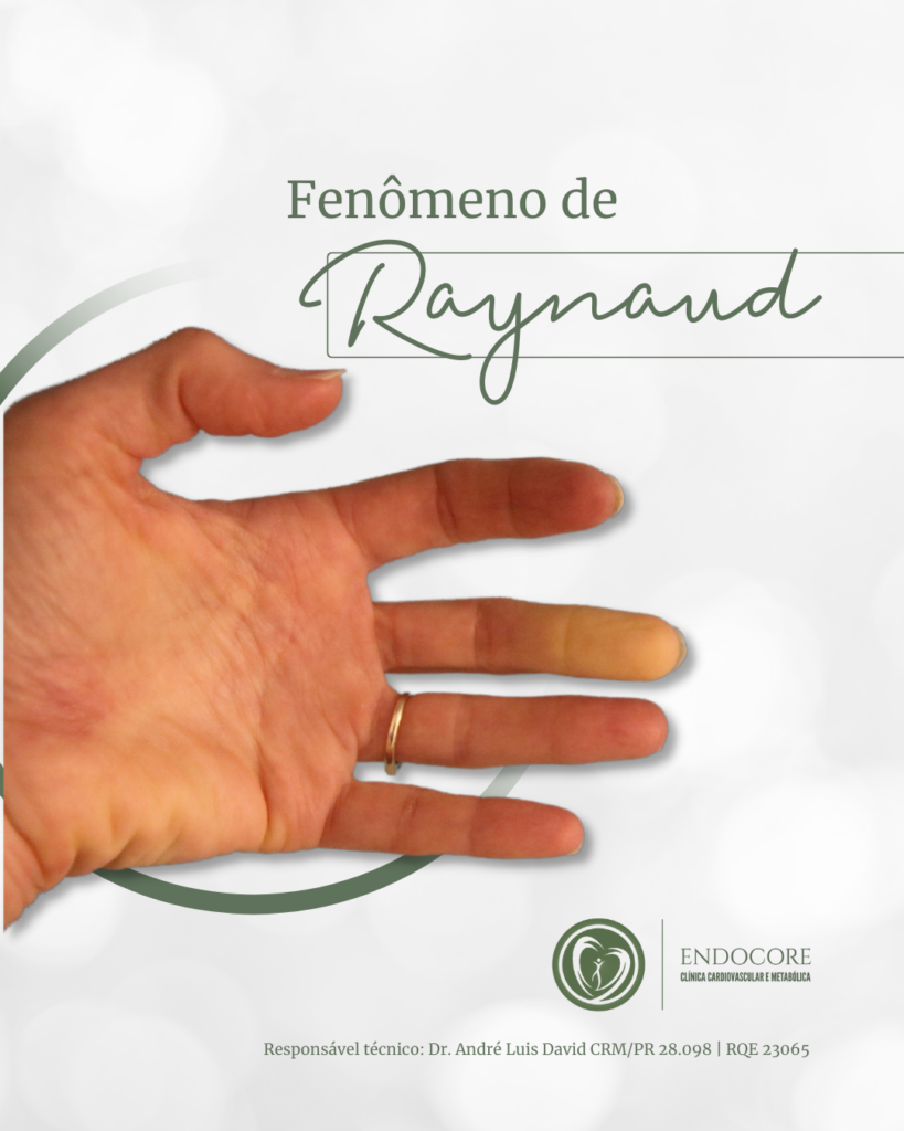 Fenômeno de Raynaud - Endocore
