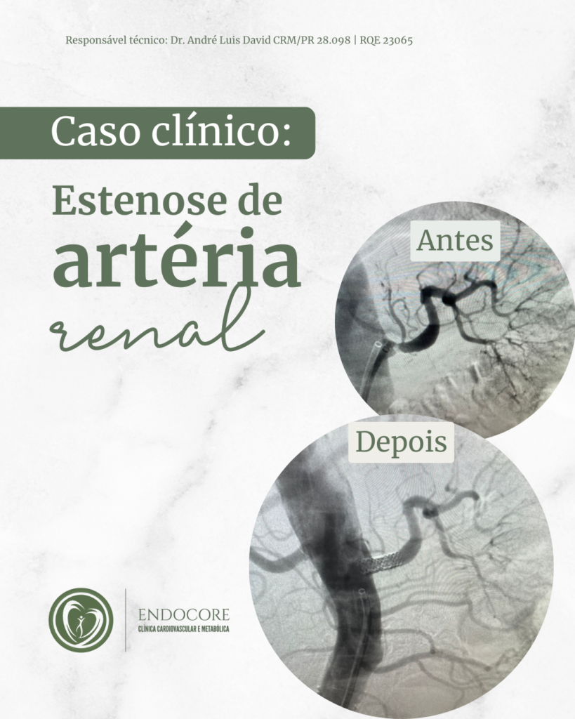 Caso clínico: estenose de artéria renal - Endocore