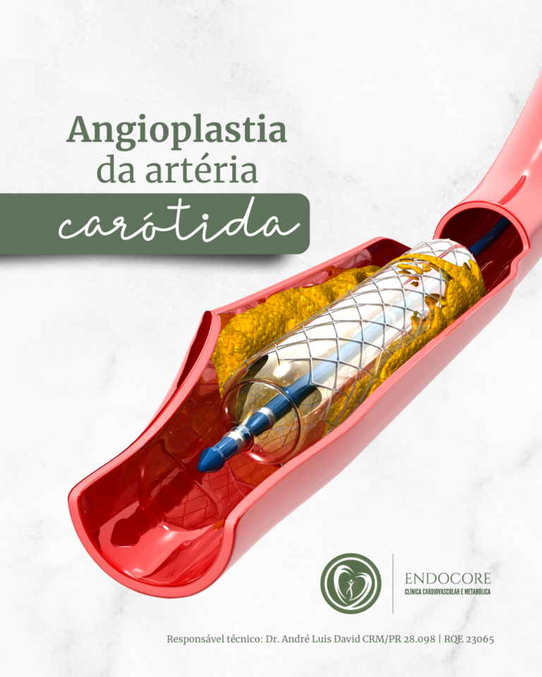 Angioplastia de artéria carótida - Endocore